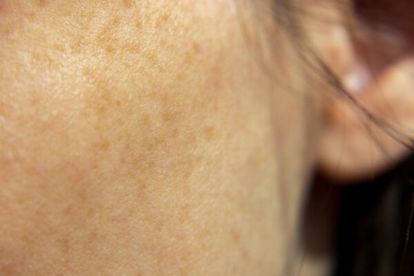 Why Skin Discolouration Happens – And How to Fix It - Twelve Beauty